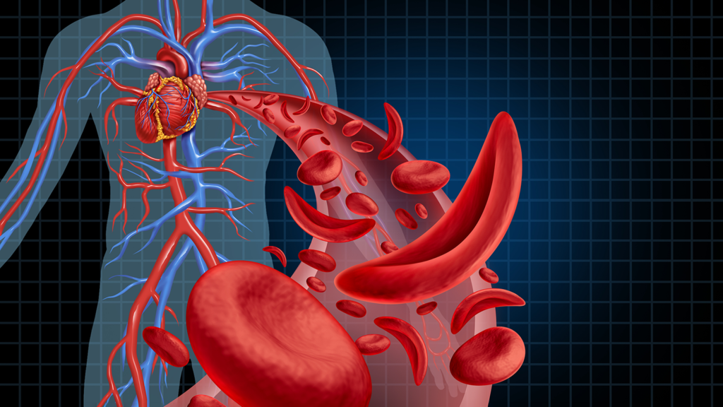 Drépanocytose : généralisation du dépistage à la naissance