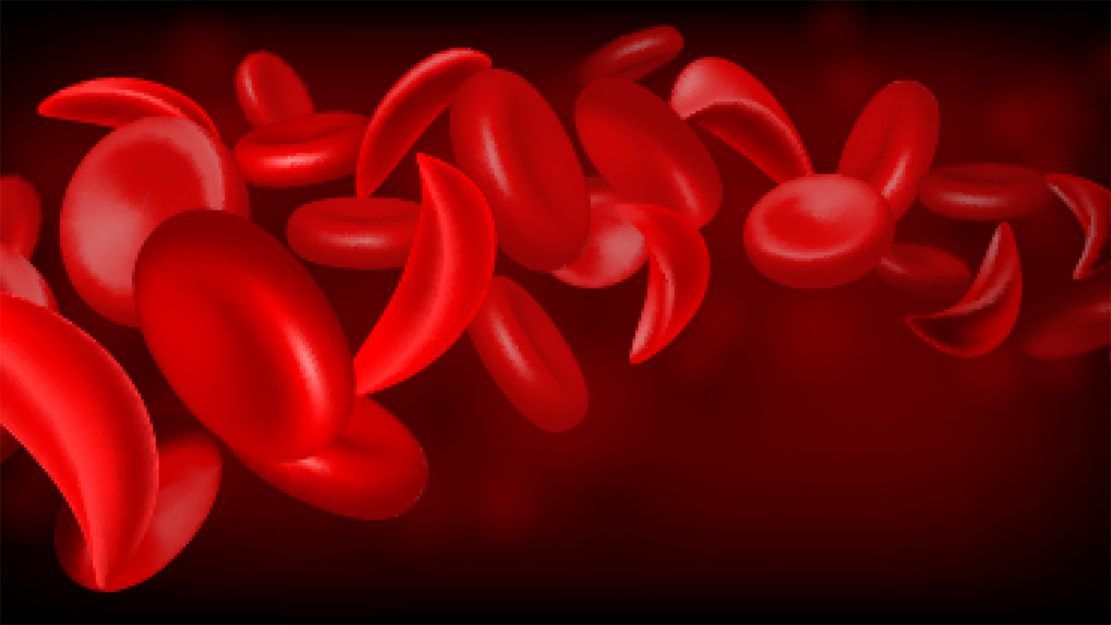 Thérapie génique pour la drépanocytose : une réalité