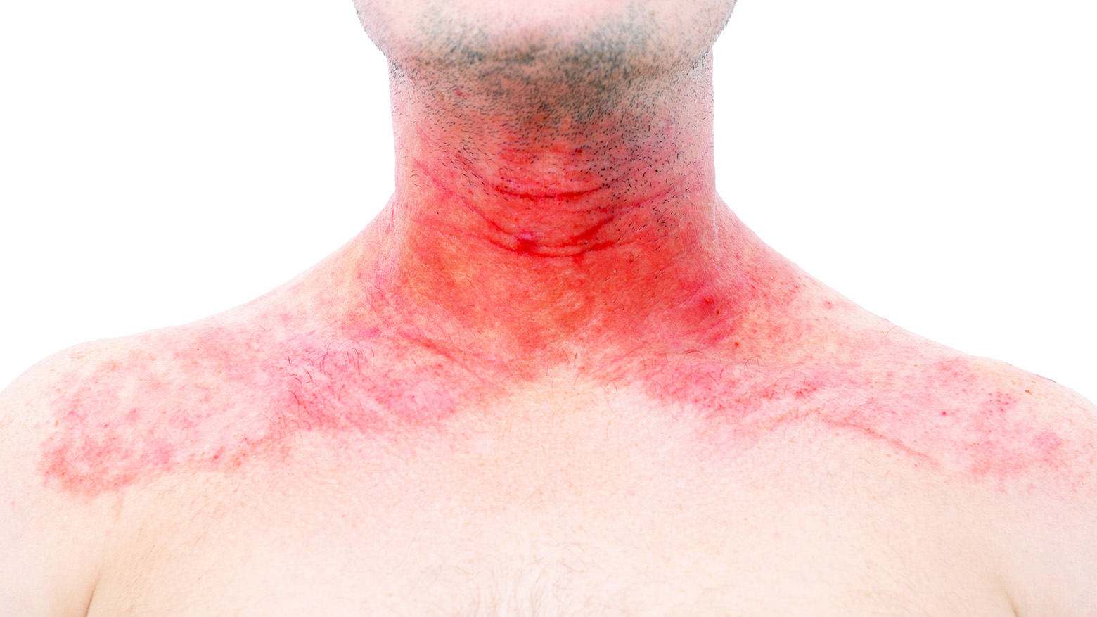 Dermatite atopique : les nouveaux traitements